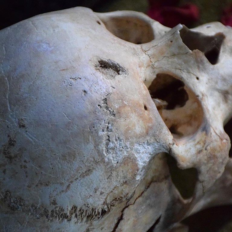 19th Century Medical Human Deformed Example at 1stDibs