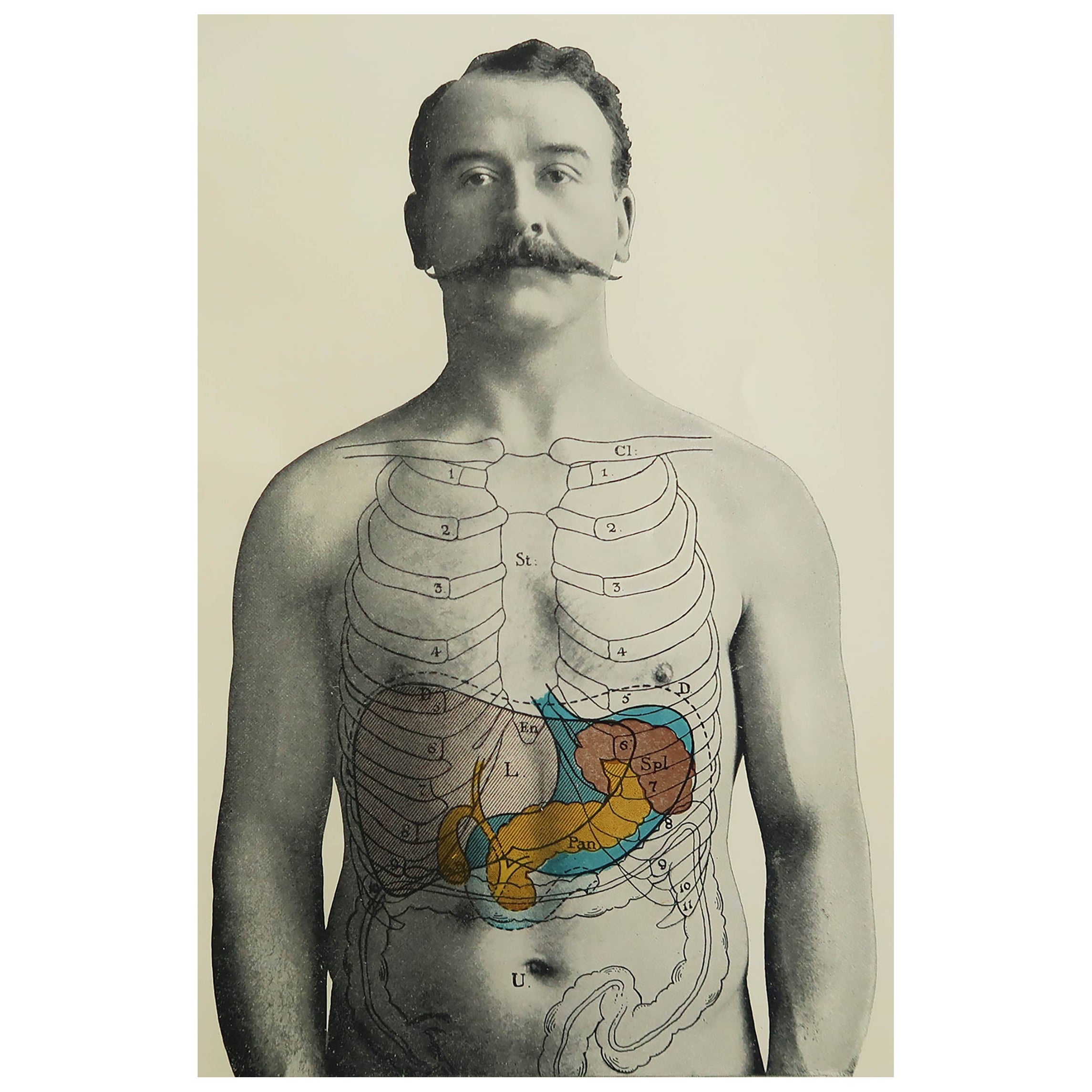Original Vintage Medical Print- Liver, Spleen and Pancreas, circa 1900 ...