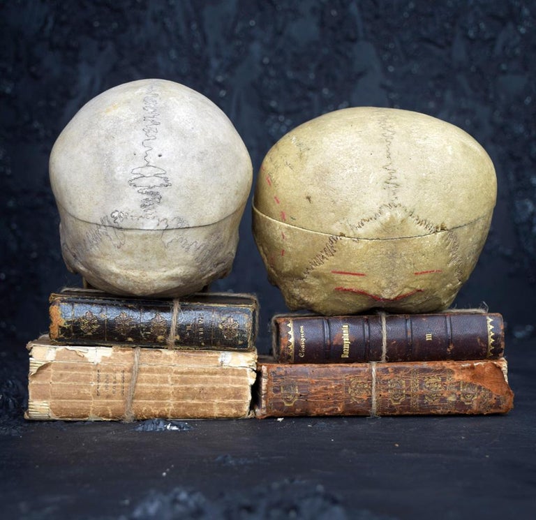 Deformed Human Skull 0.3 at 1stDibs