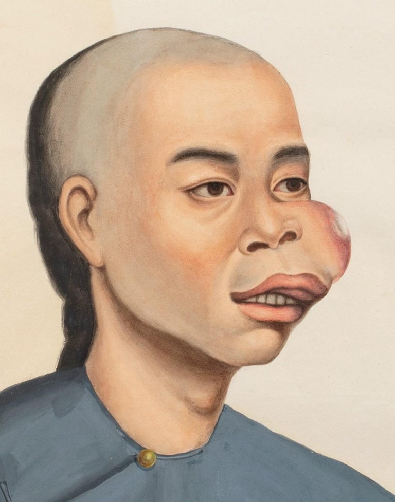 Unknown - Medical Portrait Of A Chinese Cancer Patient, 19th Century ...