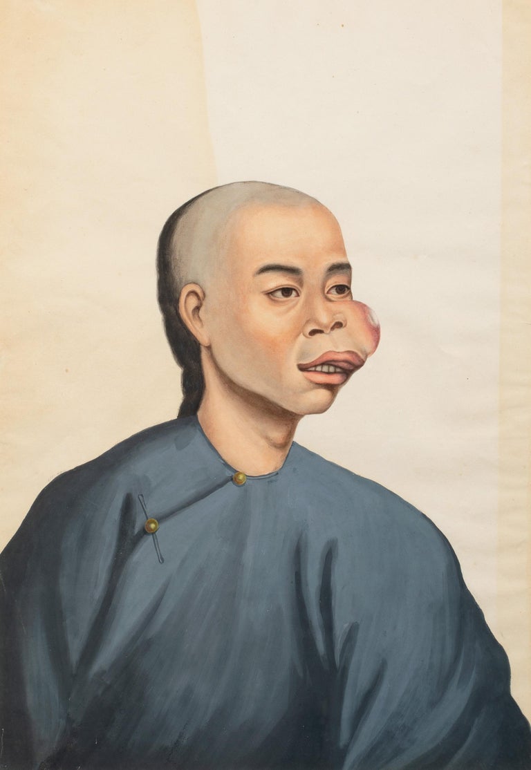 Unknown - Medical Portrait Of A Chinese Cancer Patient, 19th Century ...