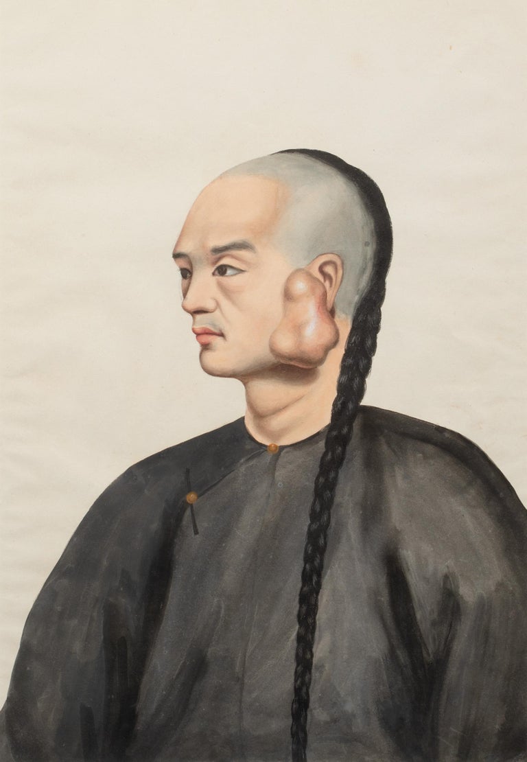 Unknown - Medical Portrait Of A Chinese Cancer Patient, 19th Century ...