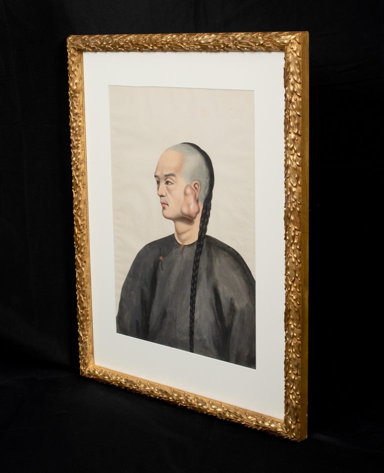 Unknown - Medical Portrait Of A Chinese Cancer Patient, 19th Century ...
