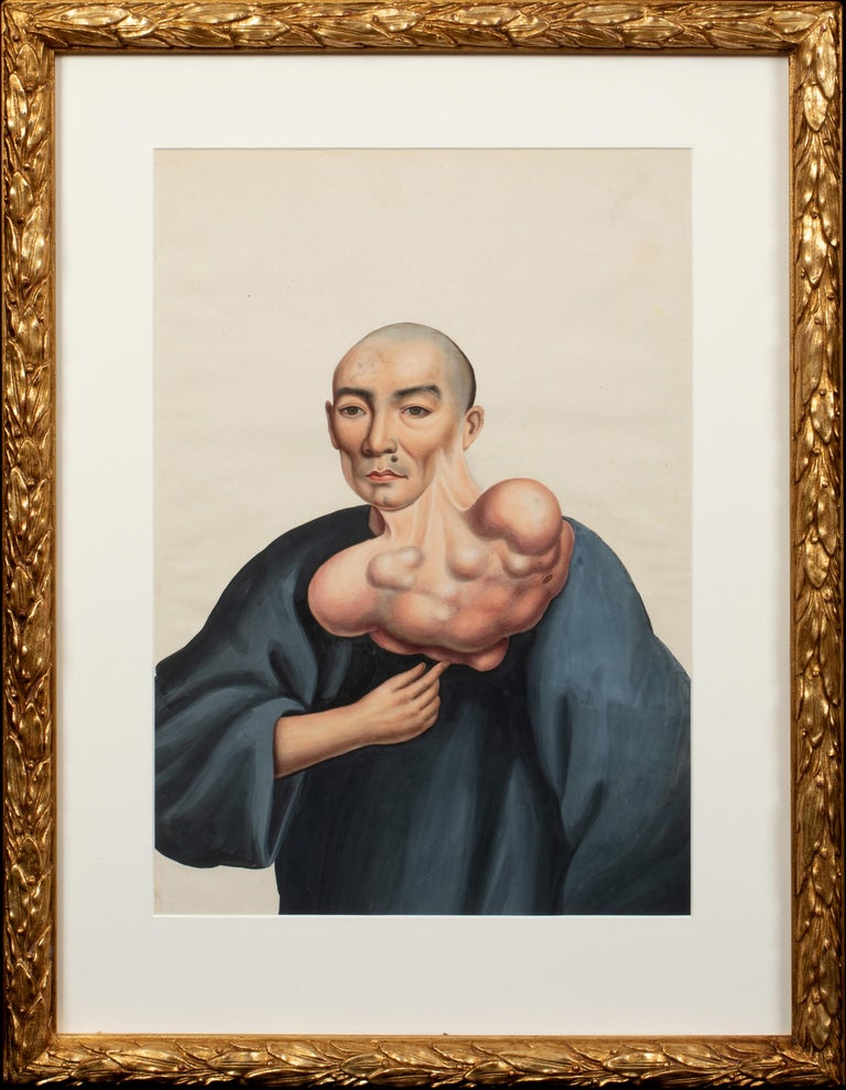 Unknown - Medical Portrait Of A Chinese Cancer Patient, 19th Century ...
